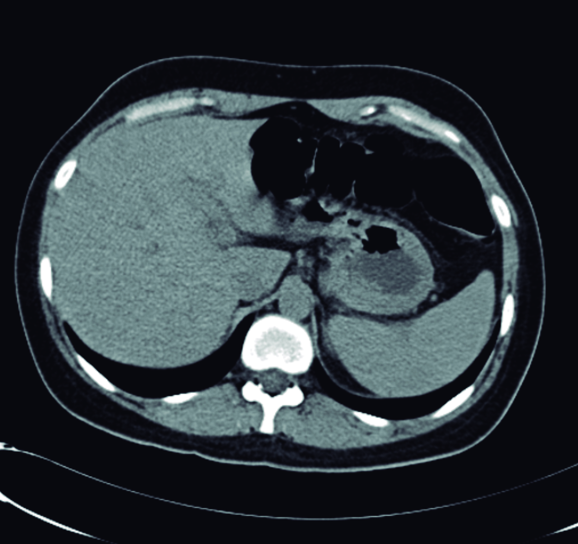 ASCARIDIASIS DE LA VÍA BILIAR: INFORME DE UN CASO